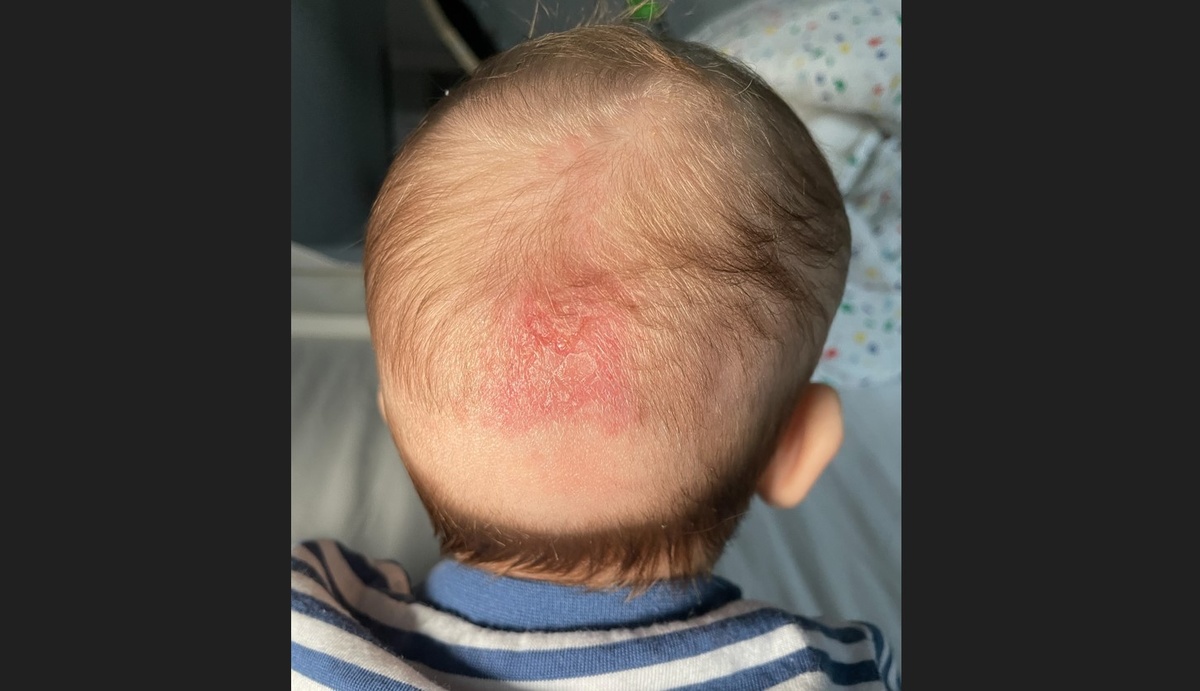 Dermatofitoza sau pecinginea la bebeluși: cauze, simptome și tratament
